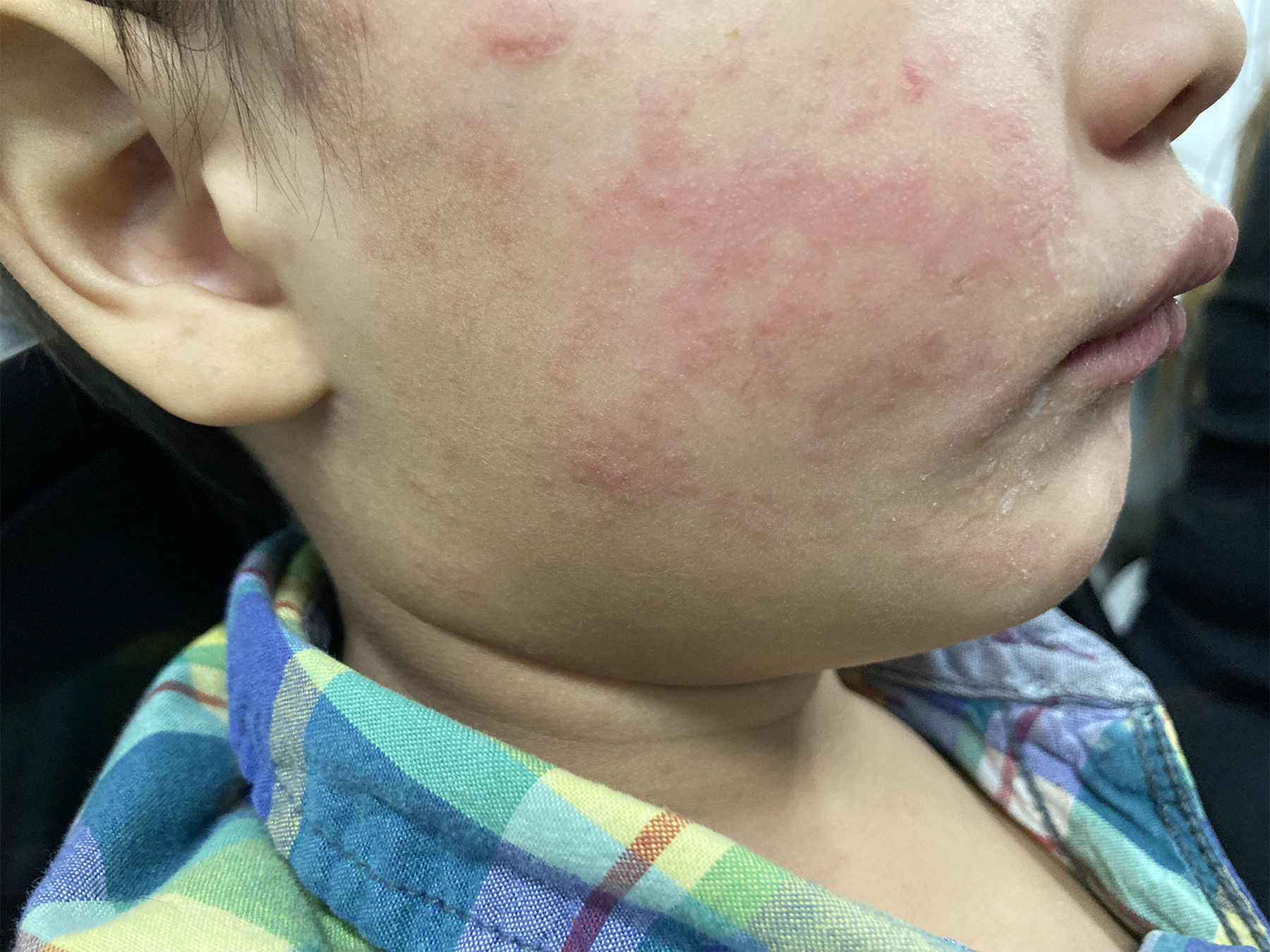 Measles Update: NC launches new Cases Dashboard | Division of Public Health